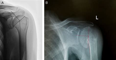 Results Of Biological Restoration Of Varus Impacted Proximal