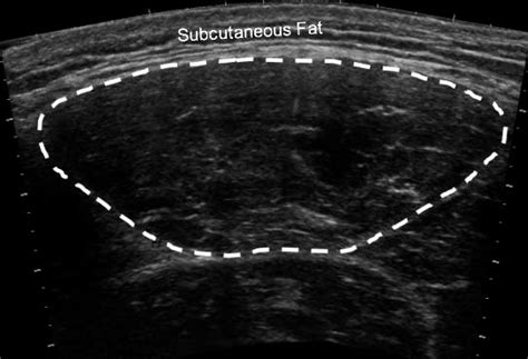 Example Of A Panoramic Ultrasound Image Of The Rectus Femoris Muscle Download Scientific Diagram