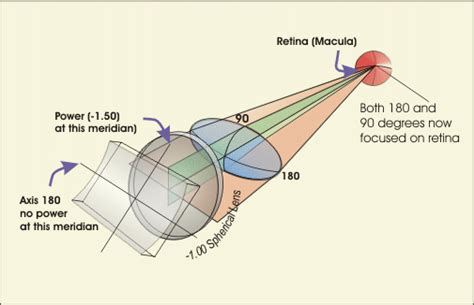 Astigmatism Antelope Mall Vision Centre Optometry Palmdale Astigmatism Optometry Medical