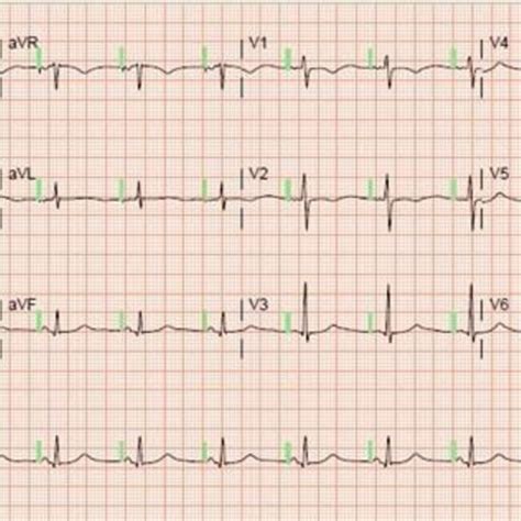 Ekg After Replacement Of Potassium And Resolution Of Symptoms Sinus