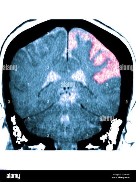 CEREBRAL ATROPHY CT SCAN Stock Photo Alamy