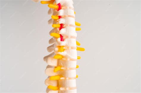 Premium Photo Lumbar Spine Displaced Herniated Disc Fragment Spinal