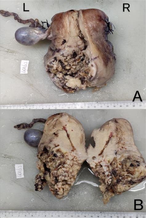 Gross Photographs A And B Show Exophytic Friable Growth In The Download Scientific Diagram