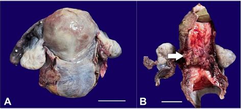 Embryonal Rhabdomyosarcoma Of The Uterine Cervix In An Adult Female