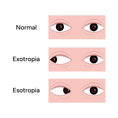 Premium Vector Eye Problem Disease Strabismus Normal Esotropia Exotropia