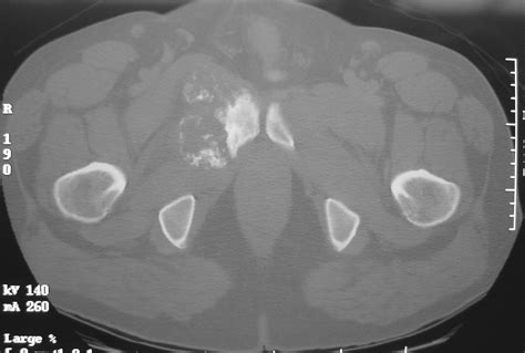 Chondrosarcoma Pathology Orthobullets