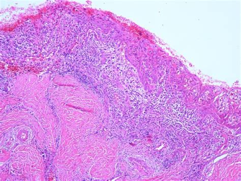 Inflammatory Cell Infiltration Into The Epithelium ×100 Download