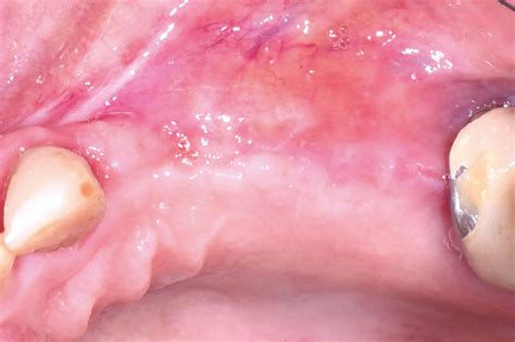 Reconstruction Of A Complex Post Extraction Defect Using Novamag