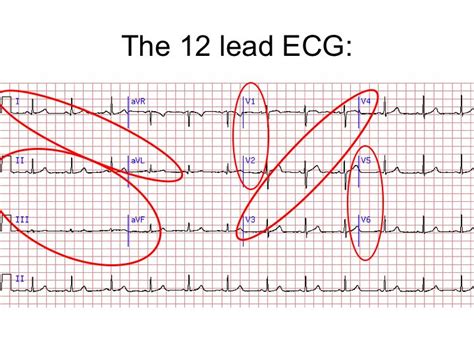 What Is Ecg 12 Lead Test At Michael Frank Blog