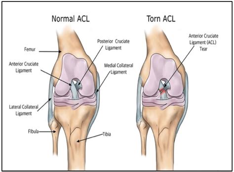 Acl Tear — Physioflow