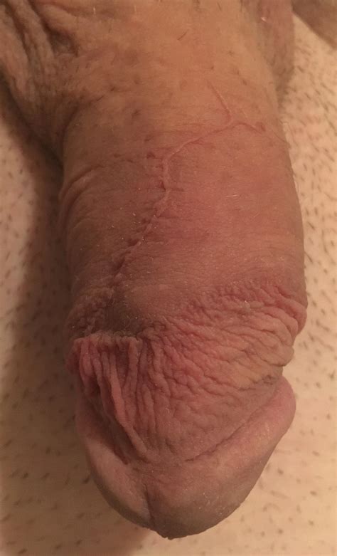Skin Ridge Scar Down The Back Side Does Anyone Know If This Was Caused