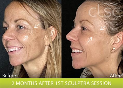 Sculptra Before And After Columbia Laser Skin Center