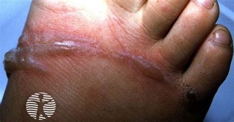 Plant Dermatitis Image