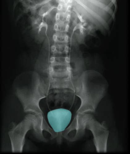 Urinary Flashcards Quizlet Urinary Flashcards Quizlet