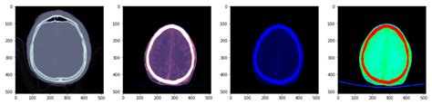 Detecting And Classifying Intracranial Hemorrhage By Kelly Zhang Medium