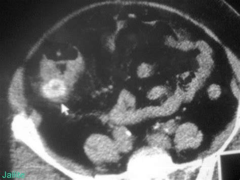 Plastron Apendicular