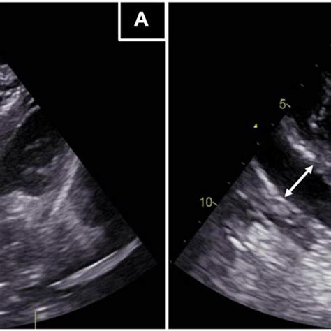Transthoracic Echocardiography The Tte Reveals A Circumferential Pe Of Download Scientific