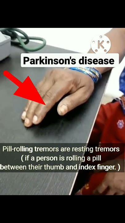 Pill Rolling Tremor