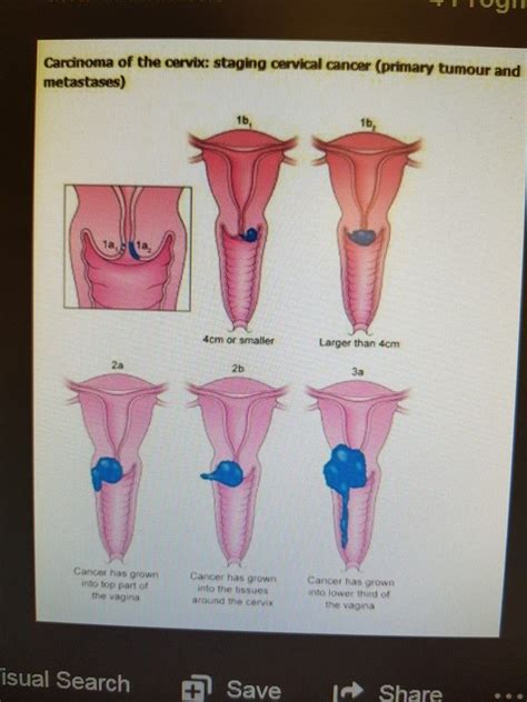 Cervical Cancer Stages Artofit