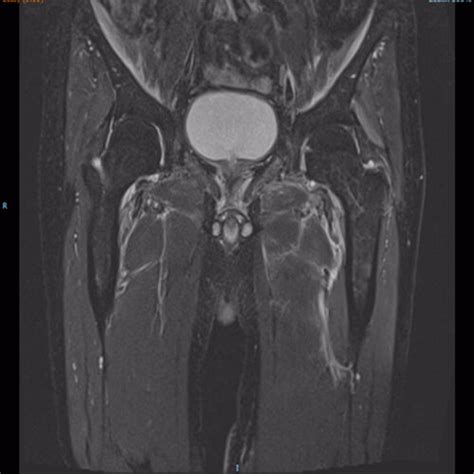 Mri With Contrast Showing Diffuse T2 Hyperintense Swelling And