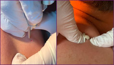 Epidermoid Cyst Archives Castle Kafka