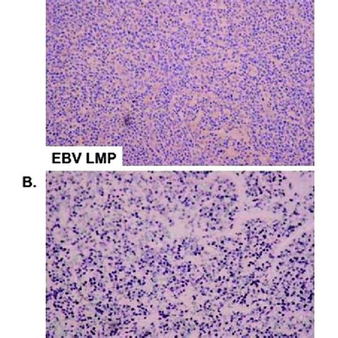 Ebv Analysis A Immunohistochemical Staining Of The Neoplastic Cells
