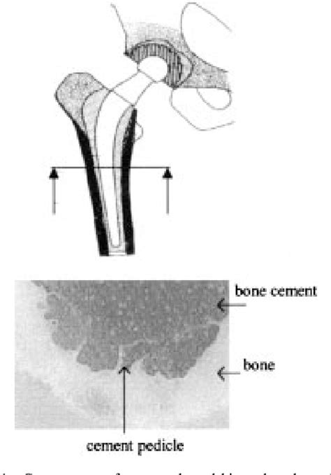 Figure 1 From Quantification Of Interdigitation At Bone Cement
