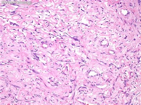 Synovial Sarcoma