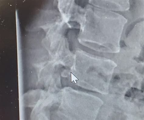 Sciatica Or Something Else Rsciatica