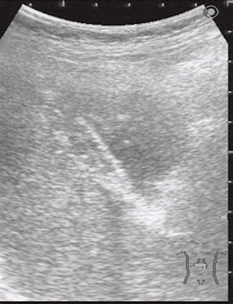 Xanthogranulomatous Cholecystitis Mimicking Gallbladder