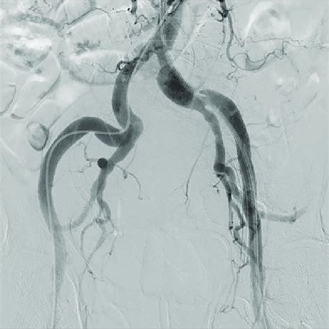 Periaortic Hematoma Located At The Aortic Root The Hematoma Was Noted