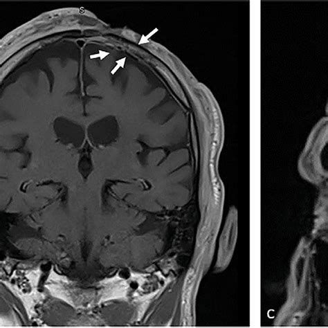 Mri Head Of The Patient With Cutaneous Angiosarcoma Of The Scalp After