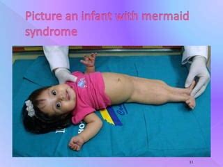 Sirenomelia A Mermaid Like Condition Pptx