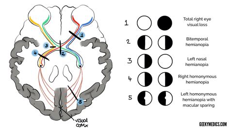 Visual Pathway And Visual Field Defects Geeky Medics