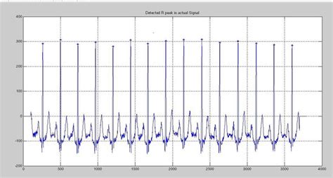 detected r peaks in sample ecg signal download scientific diagram