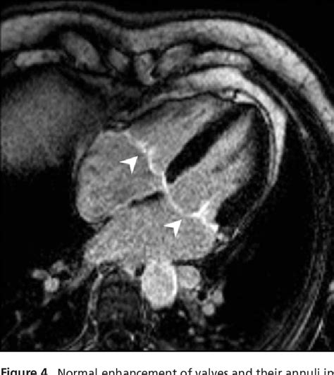 Figure 1 From Differentiation Of Myocardial Scar From Potential Pitfalls And Artefacts In