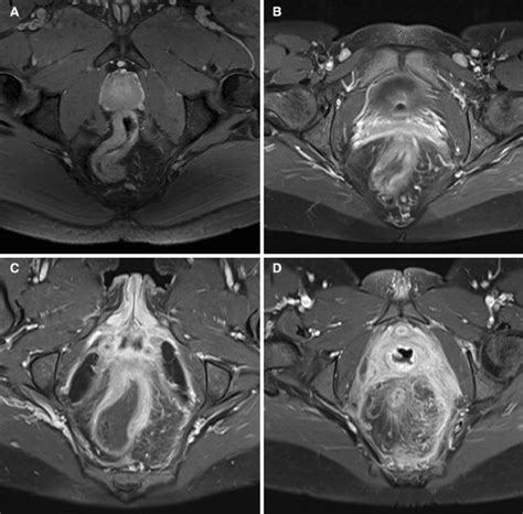 Mri Characteristics Of Proctitis In Crohns Disease On Perianal Mri