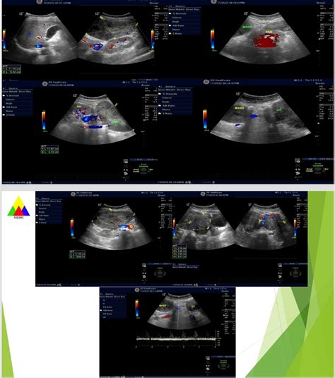 VIETNAMESE MEDIC ULTRASOUND CASE 665 INTESTINAL GIST Dr PHAN THANH HẢI Dr TRƯƠNG THỊ NGỌC