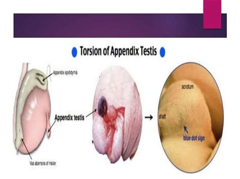 Torsion Of Appendix Testis Blue Dot Sign