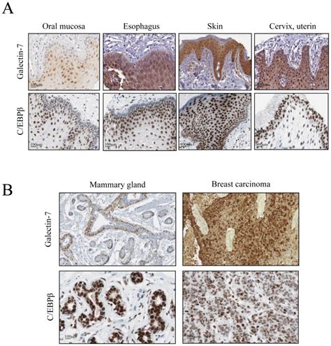 Immunohistological Analysis Of Galectine 7 And C Ebpβ Expression In A