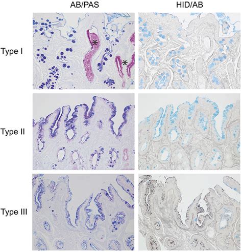 Figure 1 From Histologic Subtyping Of Gastric Intestinal Metaplasia Overview And Considerations