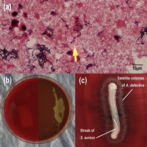 A Blood Culture Gram Stain Reveals Gram Positive Pleomorphic