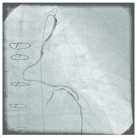 Follow Up Angio 4 Months After Pci 60 Diffuse In Stent Restenosis In Download Scientific