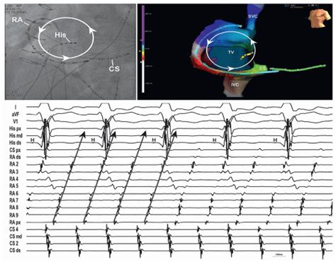 Atrial Flutter Thoracic Key