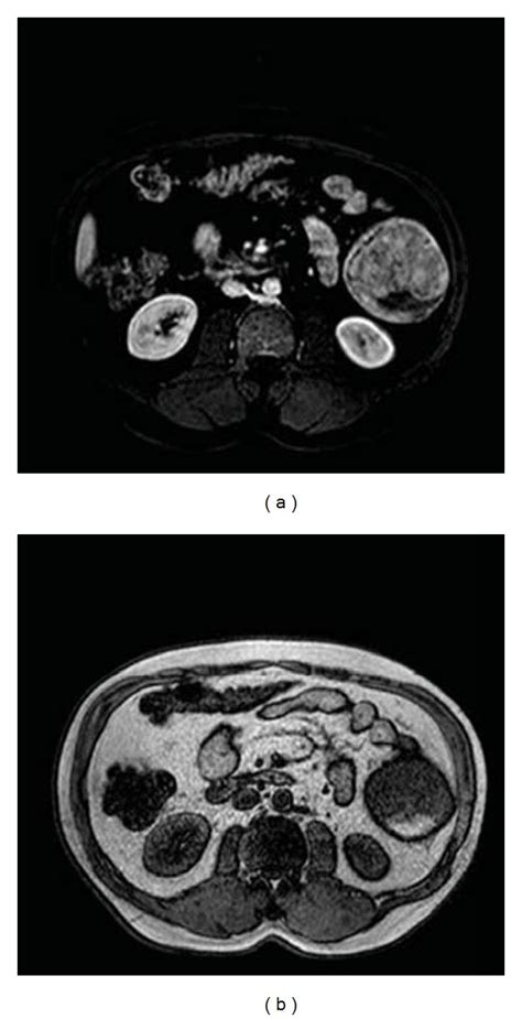 A Intense Contrast Enhancement Of Splenic Mass No Enhancement