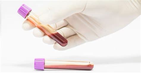 How To Increase Wbc Count Causes And Effective Solutions