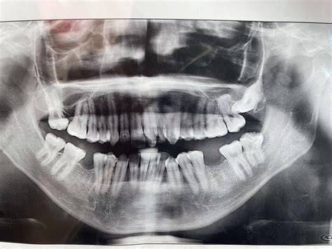 Can You Get Nasal Polyps Turbinates Bb Sinus From Fully Impacted