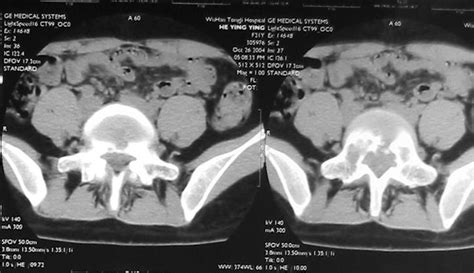 骨囊肿和骨巨细胞瘤 肿 形成 第10页 大山谷图库