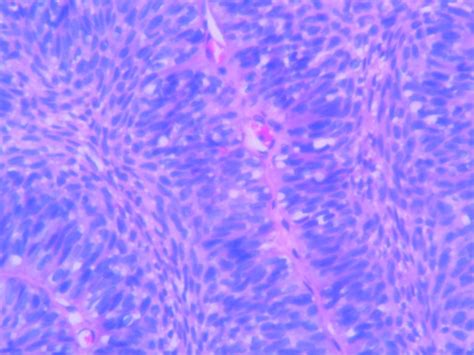 Inverted Papilloma Histopathologyguru