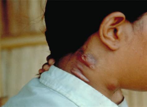 Physical Examination Tuberculosis At Alyssa Massy Greene Blog